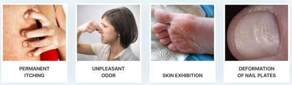 Exodermin antifungal cream review - Price and Opinions